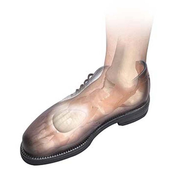 Hapad Metatarsal Pads | SME, Inc. USA